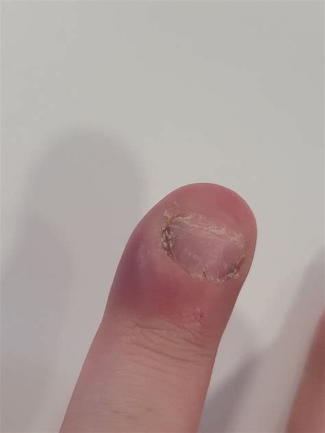 손톱 손가락 통증 지식in