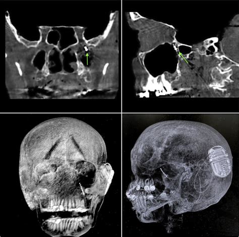 Control Computed Tomography Obtained After Neurostimulator Download Scientific Diagram
