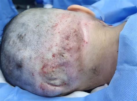 Medcare Saves Girl From One Of Worlds Largest Scalp Tumors