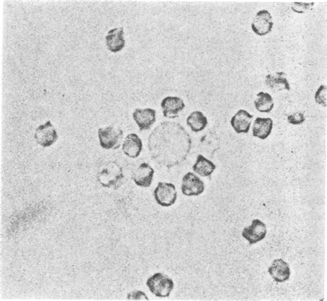 Lymphocyte From Pbl Showing Rosette Formation With Neuraminidase