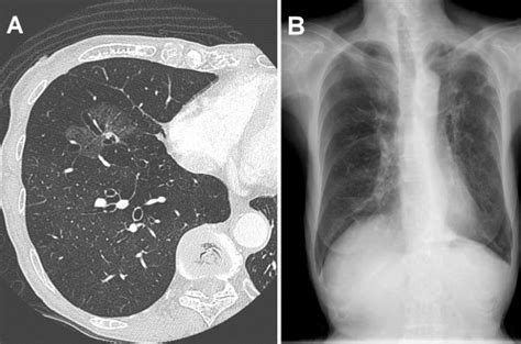 A Computed Tomography Scan Of The Chest Shows Pure Ground Glass