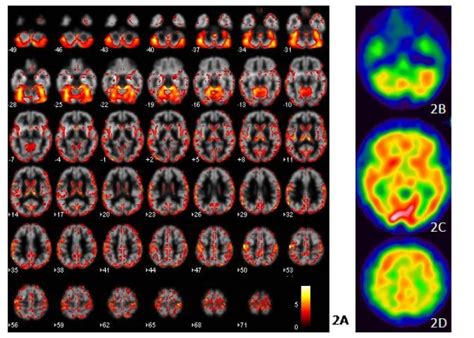 voxel based morphometry analysis maps of the t value whole brain