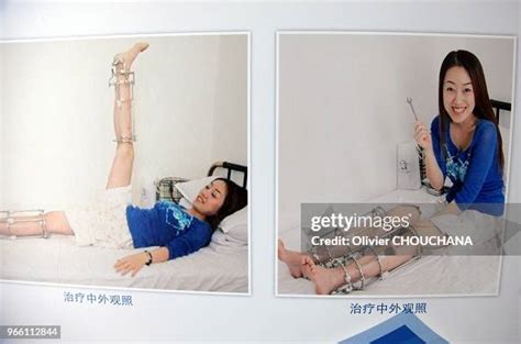 Poster Of A Chinese Patient Whose Height Was Increased By A Few News