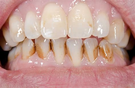 Distinguishing Tooth Decay From Tooth Erosion