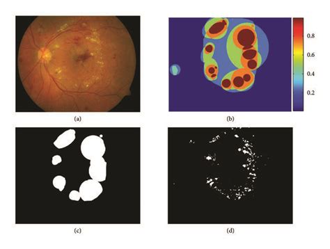 Example Of One Retinal Image In Diaretdb1 Database A Original Image