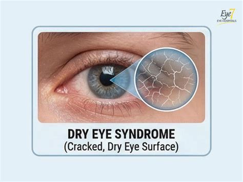 22 Eye Diseases Symptoms Causes Treatments And Cost