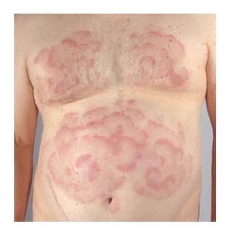 Erythema Gyratum Perstans
