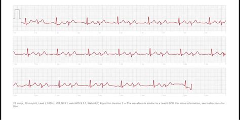 Is This Cause For Concern Wife Has Multiple Ecgs Like This Over The Course Of Weeks 29f R