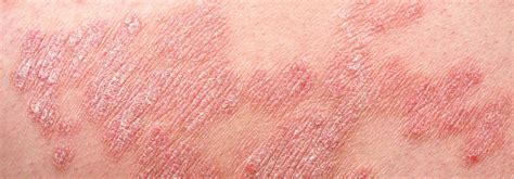 Find A Dermatology Clinic Near You Stratum Dermatology Clinics