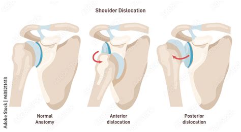 Shoulder Dislocation Types Arm Injury Upper Arm Bone Pops Out Of The Cup Stock Vector Adobe Shoulder Dislocation Types Arm Injury Upper Arm Bone Pops Out Of The Cup Stock Vector Adobe