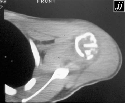 Msk Left Humerus Fracture Radioogle