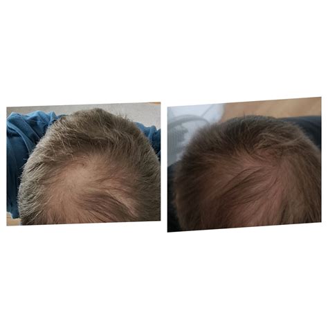 6 Months Of Dutasteride And Topical Minoxidil Before And After R Tressless