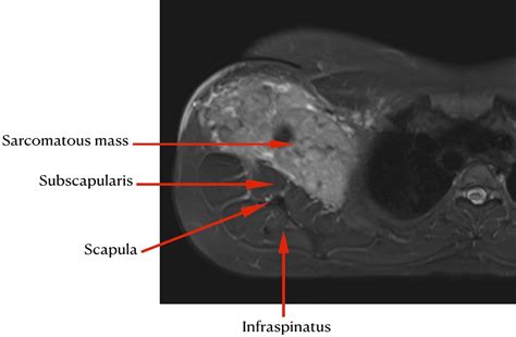 Sarcoma In Pregnancy Radiation Risks Dilemmas And Choices A Case