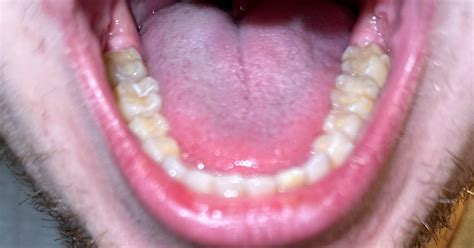 bottom row finished r invisalign