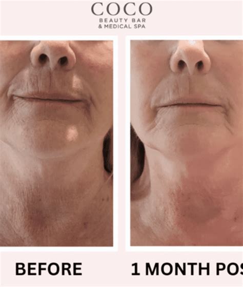 Pixel8 Rf Microneedling Coco Beauty Bar And Medical Spa