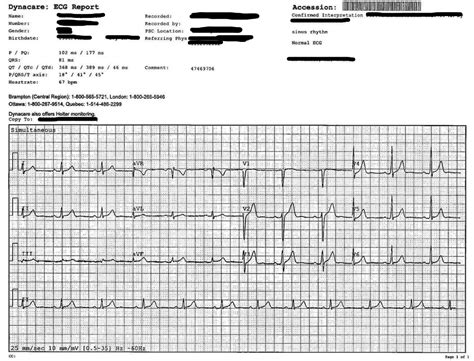 Please Help Me Read My Ecg Recg