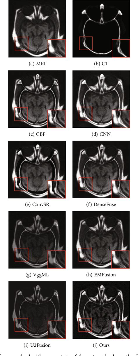 Figure 4 From Multimodal Brain Image Fusion Based On Improved Rolling Guidance Filter And Wiener