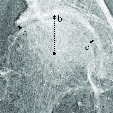 Measurement Of The Minimum Joint Space Width Jsw The Minimum Jsw Was Download Scientific