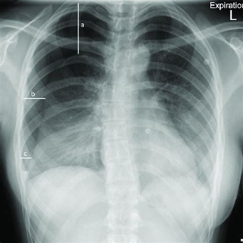 Pdf Pneumothorax Classification And Etiology