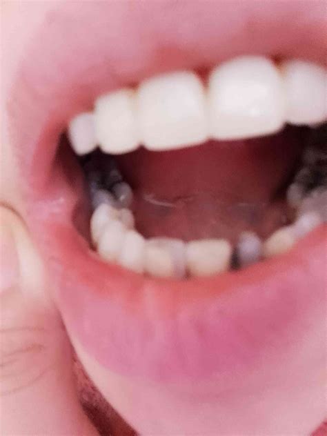 من فضلك ما الحل من صغري اعاني من تسوس الاسنان الان ومزلت الطبي