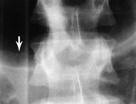 Transverse Process Fracture X Ray