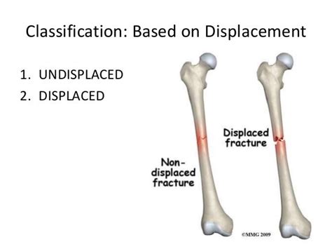 Classification Of Fractures And Compound Fracture Managment Classification Of Fractures And Compound Fracture Managment