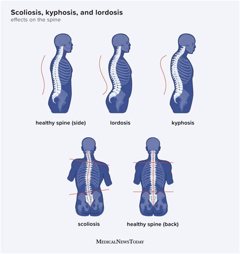 Scoliosis Kyphosis And Lordosis Key Differences