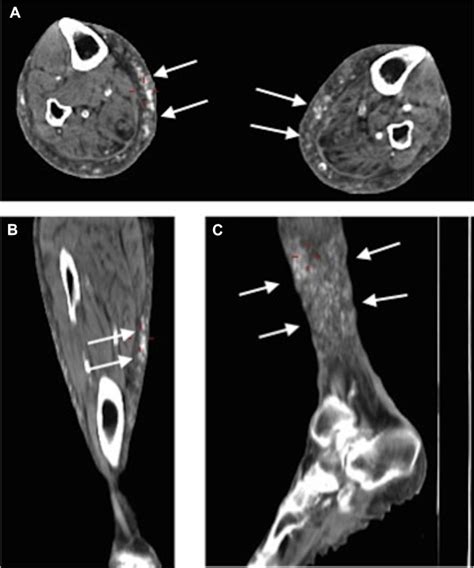 Calciphylaxis On Bone Scan Correlation Between Molecular And Cross