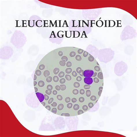Leucemia Linfoide Aguda Atlas Em Hematologia