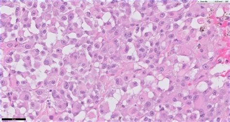 Choroidal Melanoma Epitheloid Retina Image Bank