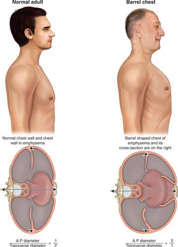 Barrel Chest Copd Emphysema