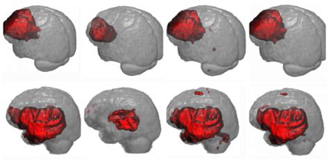 Volumetric Multimodality Neural Network For Brain Tumor Segmentation Biomedical Computer Vision
