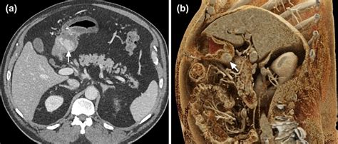Gastrointestinal Stromal Tumor In A 70 Year Old Male A Axial