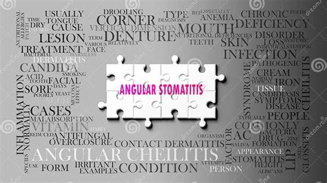 Angular Stomatitis As A Complex Subject Related To Important Topics Spreading Around As A Word