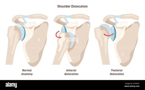Shoulder Dislocation Types Arm Injury Upper Arm Bone Pops Out Of The