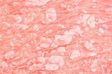 Myths Facts Psoriatic Arthritis