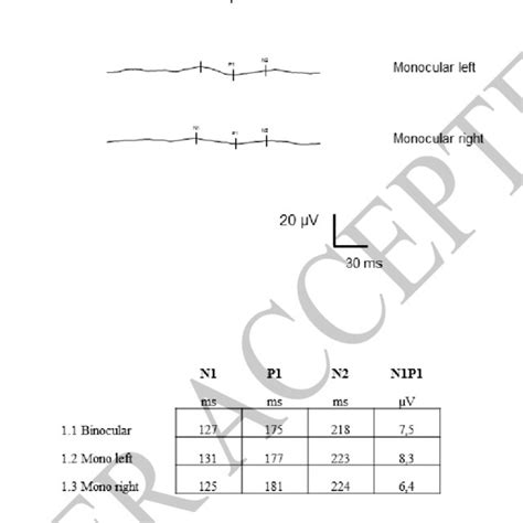 Characteristic Altitudinal Visual Field Defect Of An Aion Humphrey