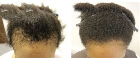 Worlds Leading Traction Alopecia Treatment Center In Nyc Dr Gary