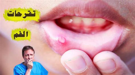 علاج تقرحات الفم عند الأطفال Youtube