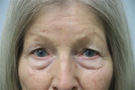 Blepharoplasty Case 3978 Dr Guy