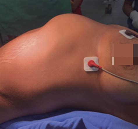 Idiopathic Giant Pancreatic Pseudocyst