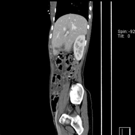 Normal Ct Enterography Radiopaedia 30357 31000 D Nc Commons