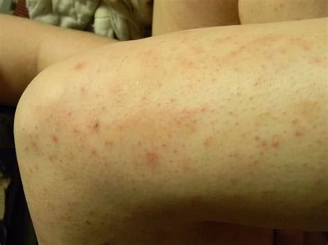 Red Razor Bumps On Legs At Vernon Marshal Blog