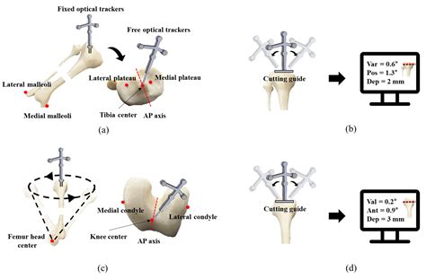 Rapid Estimation Of Contact Stresses In Imageless Total Knee Arthroplasty