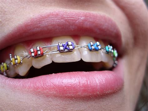 Fake Braces Asia S Curious Teenage Fashion Trend Artofit
