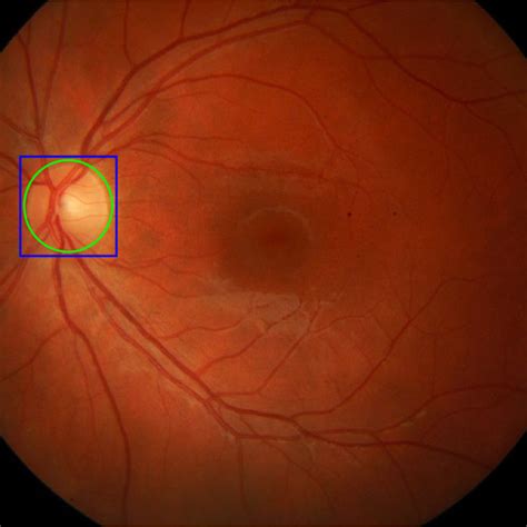 Pdf Optic Disc Detection From Fundus Photography Via Best Buddies Similarity