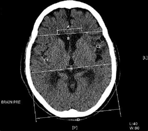 Measurement Of Brain Atrophy Using Frontal Horn Index Fhi And Download Scientific Diagram
