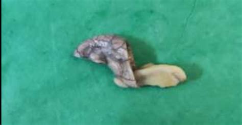 Gross Appearance Of A Submucosal Nodule At The Tip Of Appendix