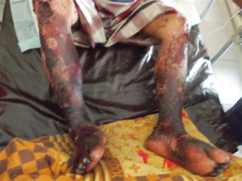 Ruang Praktek Bedah Dokter Ramzi Spb K V Vaskulitis Suatu Proses Inflamasi Dan Infeksi Pada