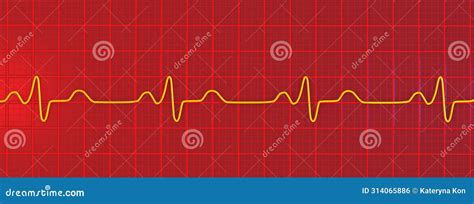 Ecg Of Bundle Branch Block 3d Illustration Royalty Free Cartoon 314065940